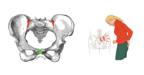 Symphysis Pubis Dysfunction Spd